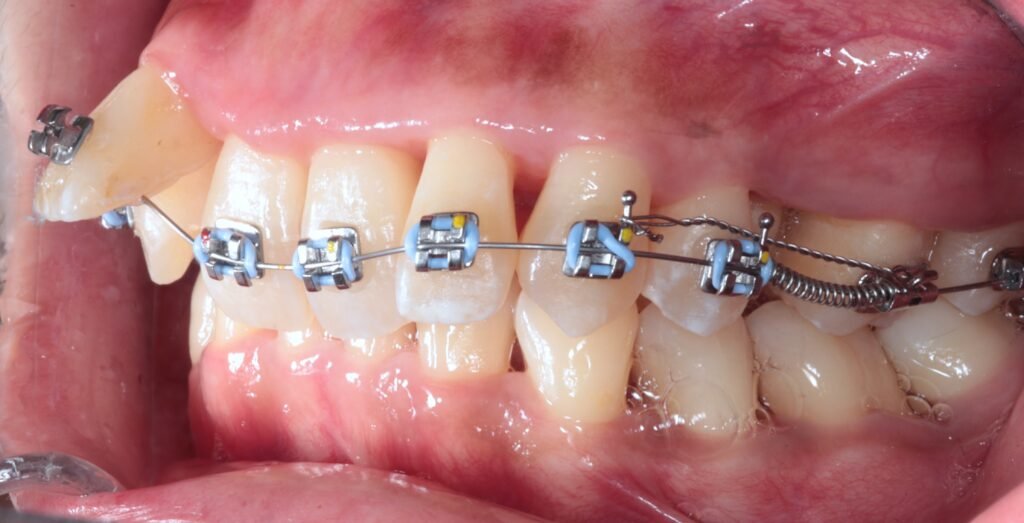 Braces Kuala Lumpur
