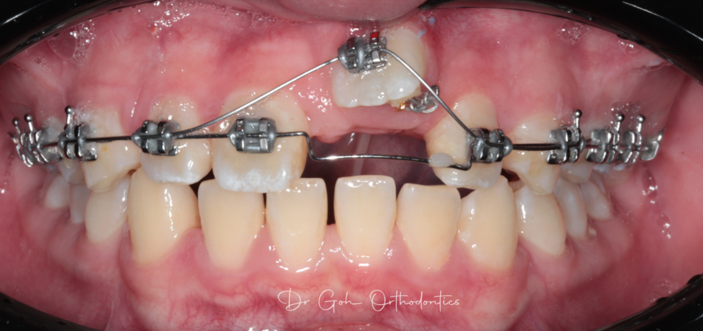 Braces Kuala Lumpur
